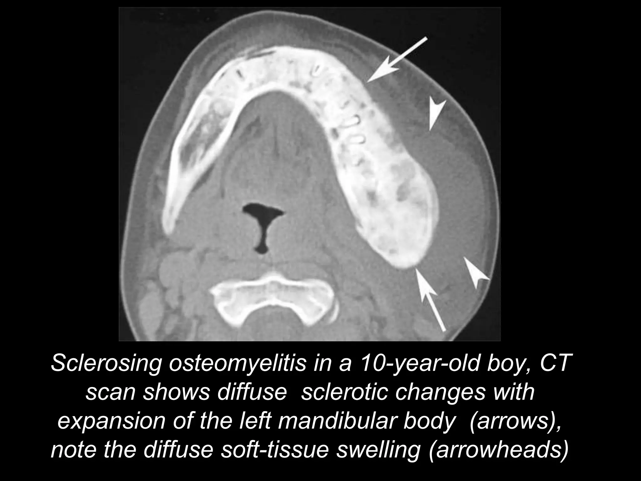 Introduction to radiological diagnosis of osteomyelitis for ...