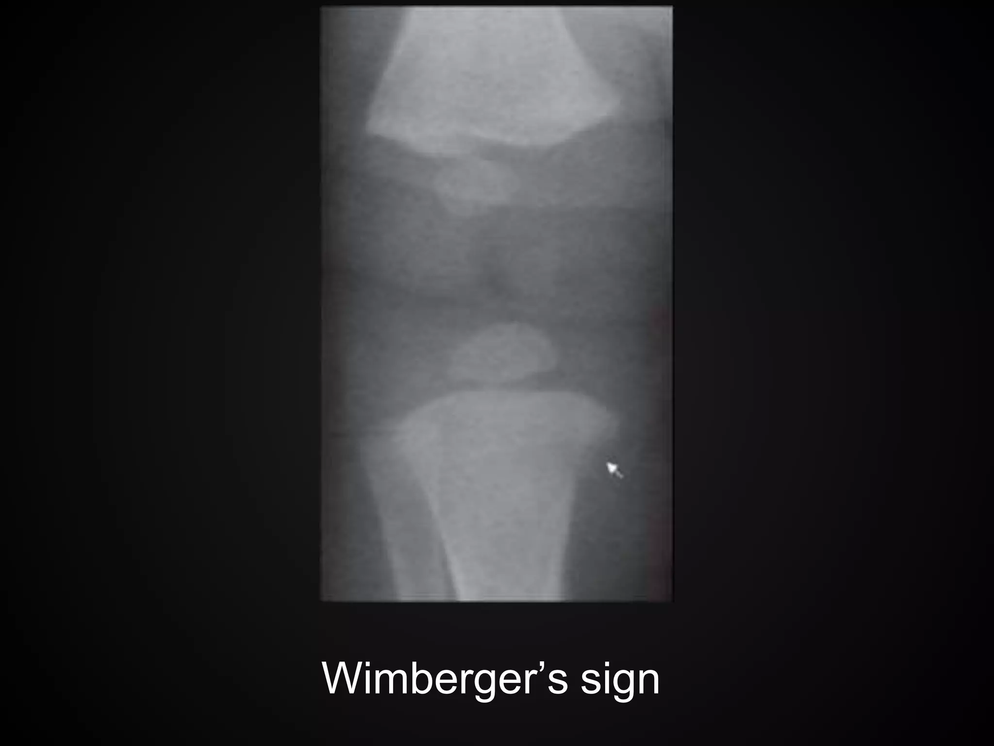 Introduction to radiological diagnosis of osteomyelitis for ...