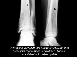 Introduction to radiological diagnosis of osteomyelitis for ...