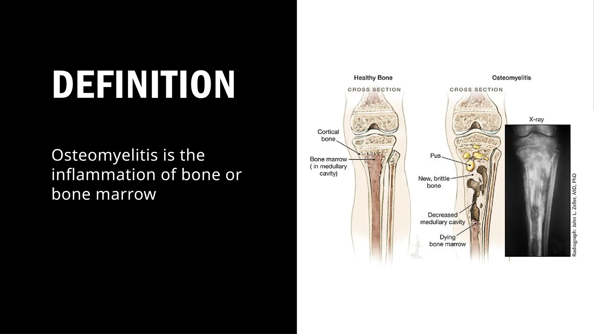 Surgical aspects of osteomyleitis. .pptx