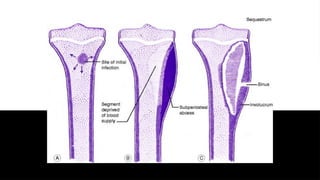 Surgical aspects of osteomyleitis. .pptx