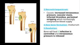Surgical aspects of osteomyleitis. .pptx