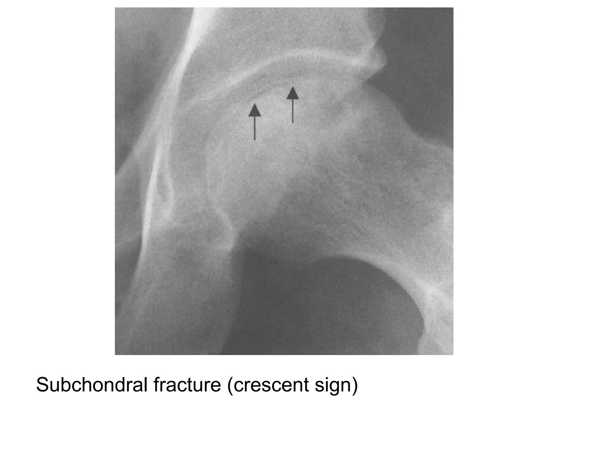 Diagnostic Imaging of Osteonecrosis & Osteochondrosis | PPT