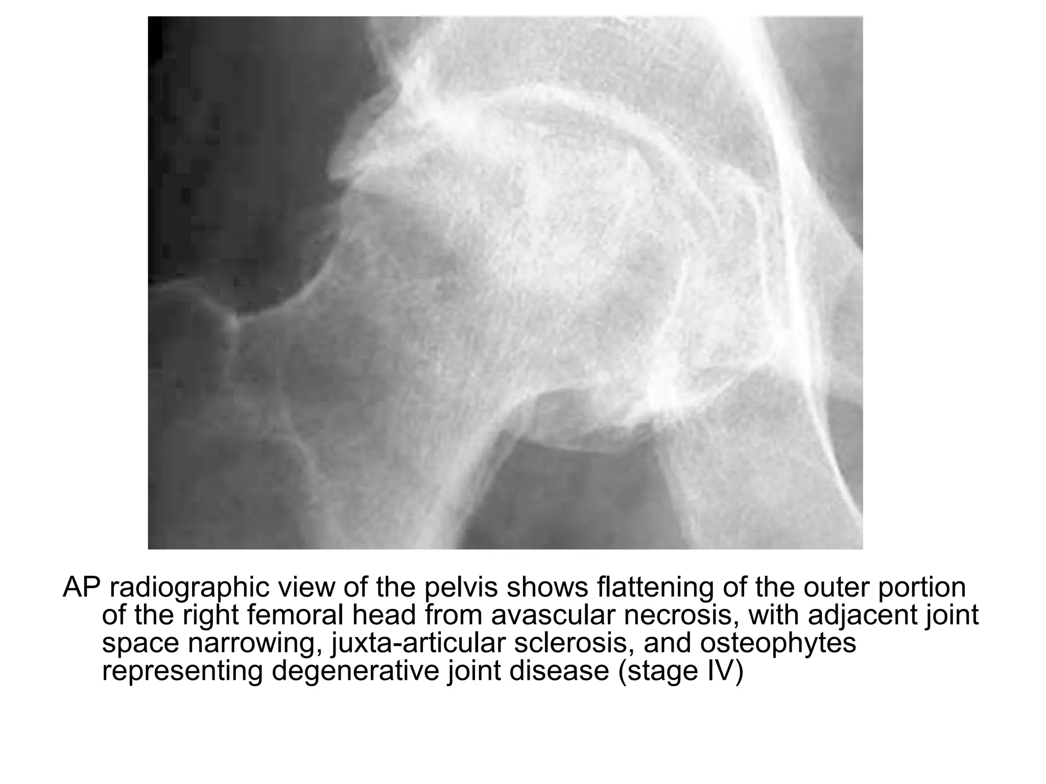 Diagnostic Imaging of Osteonecrosis & Osteochondrosis | PPT