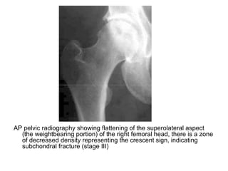 Diagnostic Imaging of Osteonecrosis & Osteochondrosis | PPT