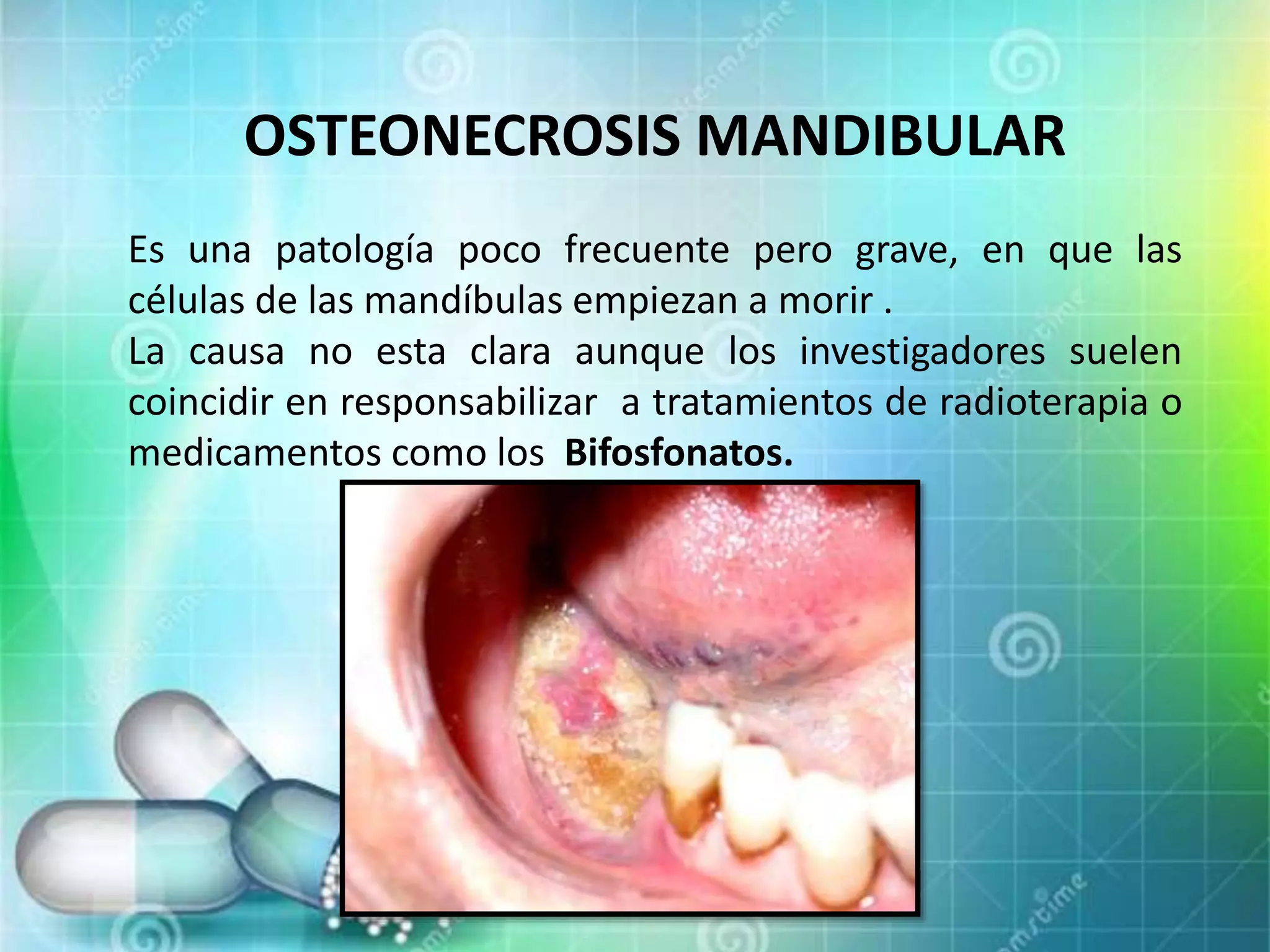 Osteonecrosis Mandibular | PPT