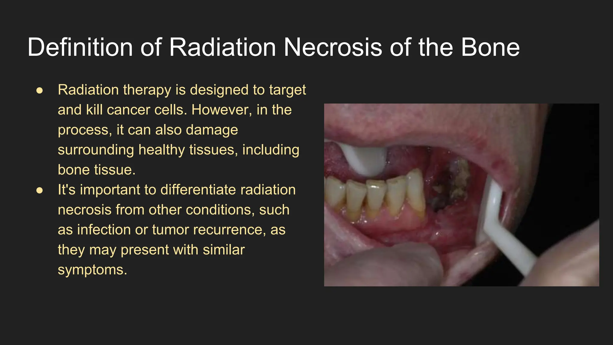 Osteonecrosis: Radiation Necrosis of the Bone | PPTX