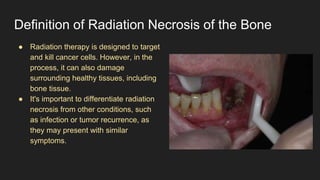 Osteonecrosis: Radiation Necrosis of the Bone | PPT