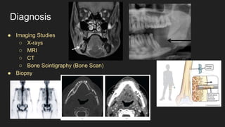 Osteonecrosis: Radiation Necrosis of the Bone | PPT