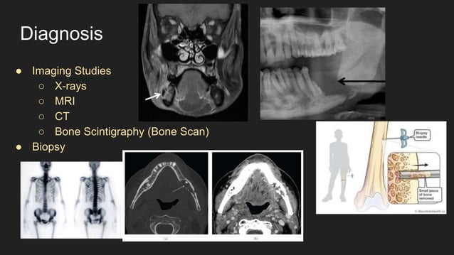Osteonecrosis: Radiation Necrosis of the Bone | PPT