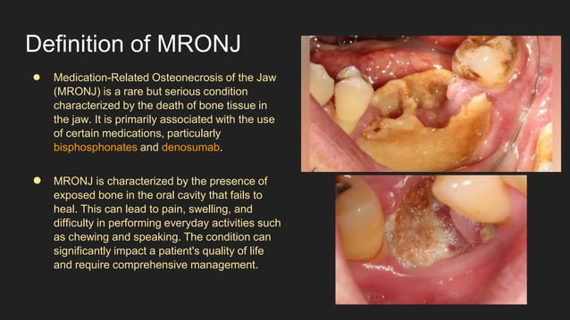 Osteonecrosis: Radiation Necrosis of the Bone | PPT