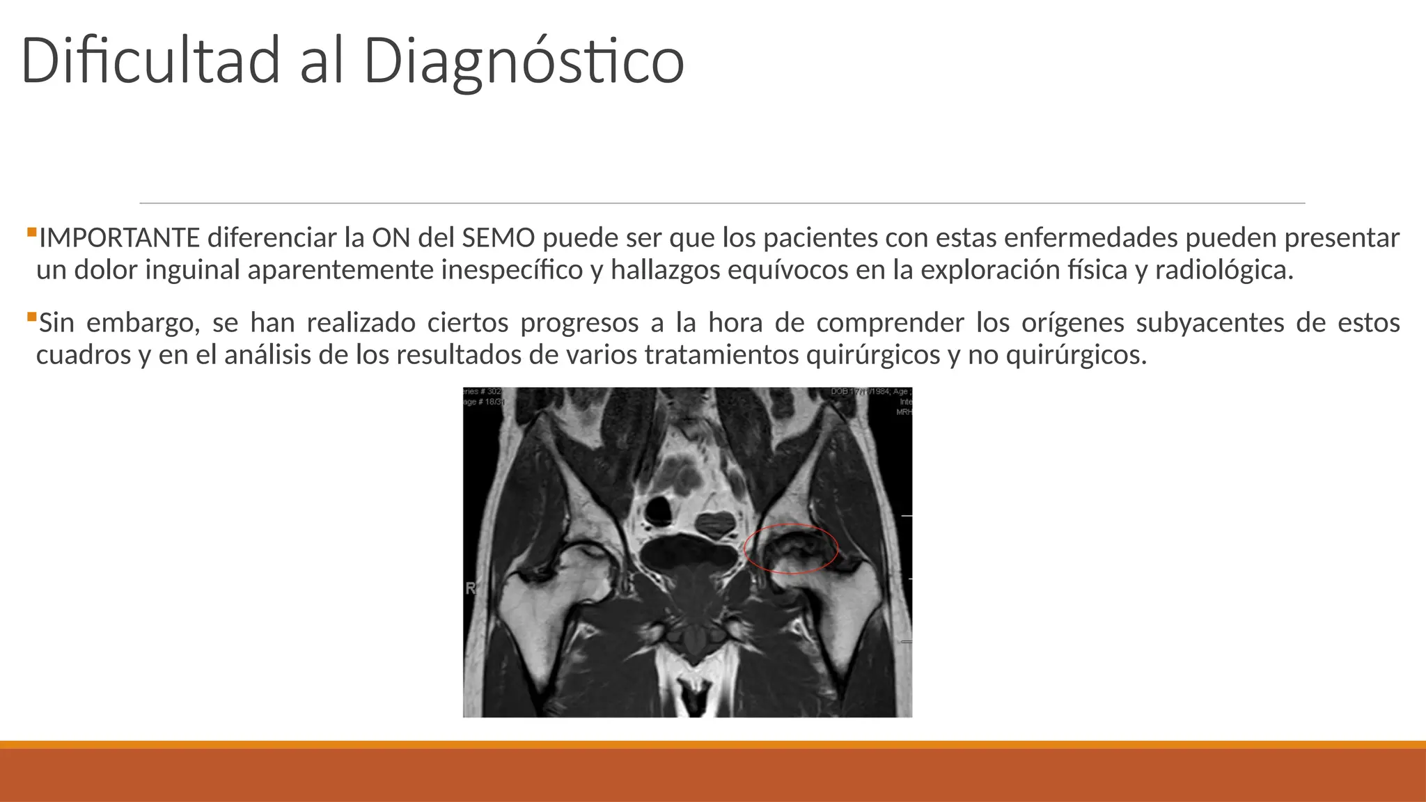 Osteonecrosis Femoral (NAV) y Síndrome de Edema Medular óseo | PPT
