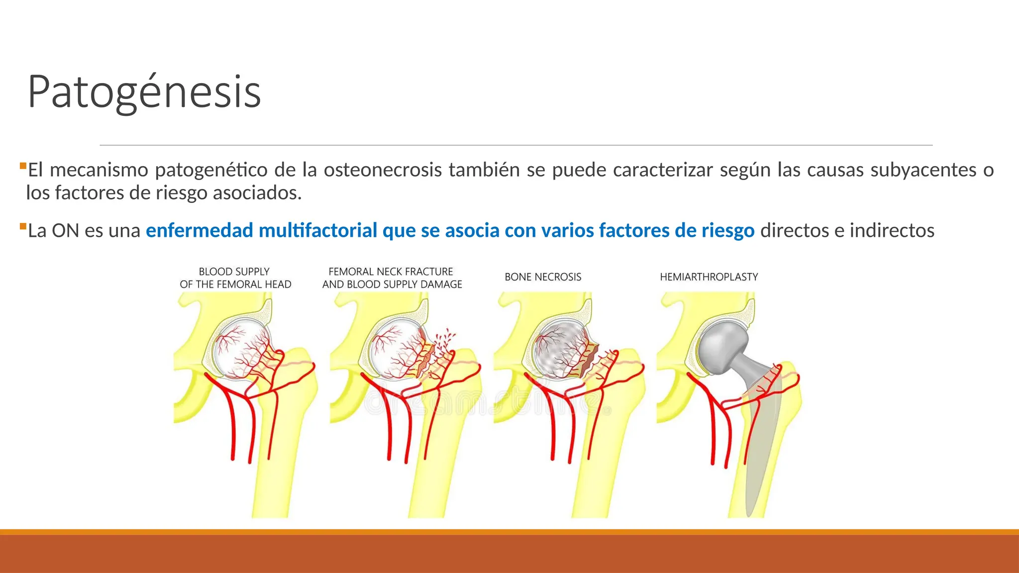Osteonecrosis Femoral (NAV) y Síndrome de Edema Medular óseo | PPT