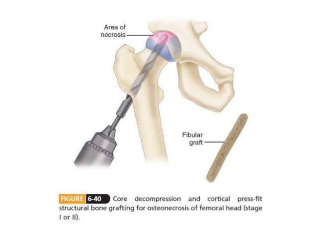 Osteonecrosis of the femoral head