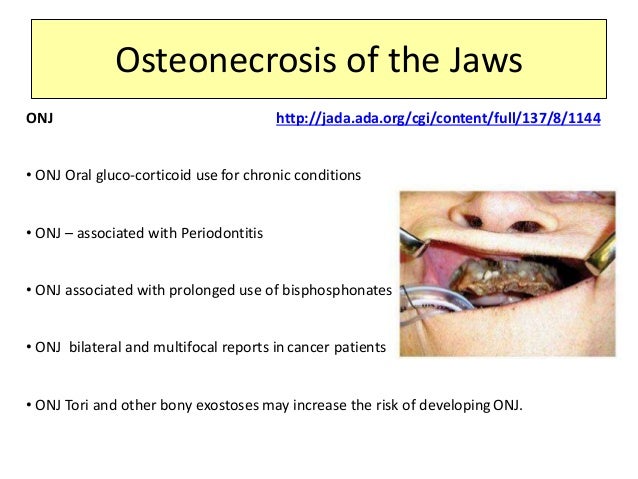 Osteonecrosis Of The Jaws