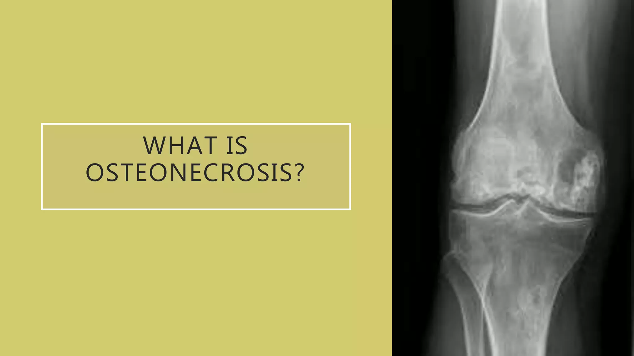 Osteonecrosis | PPT