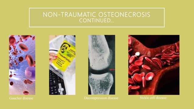 Osteonecrosis | PPT