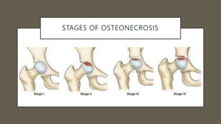 Osteonecrosis | PPT