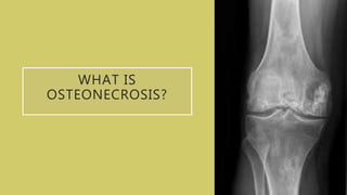 Osteonecrosis | PPT