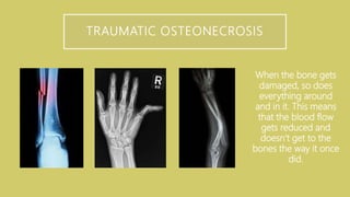 Osteonecrosis | PPT