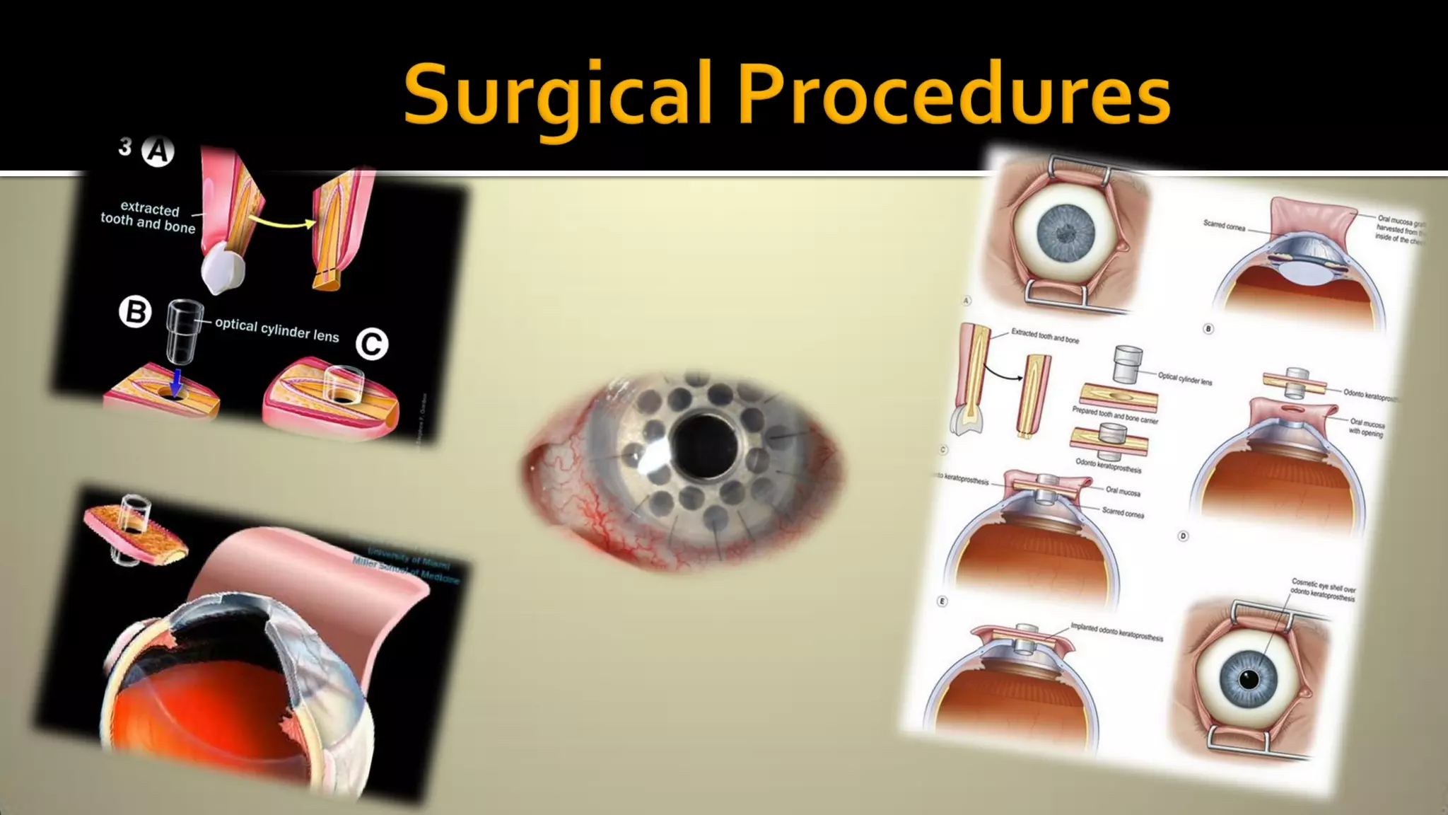 Osteo odonto kerato prosthesis | PDF | Eye and Vision Conditions ...