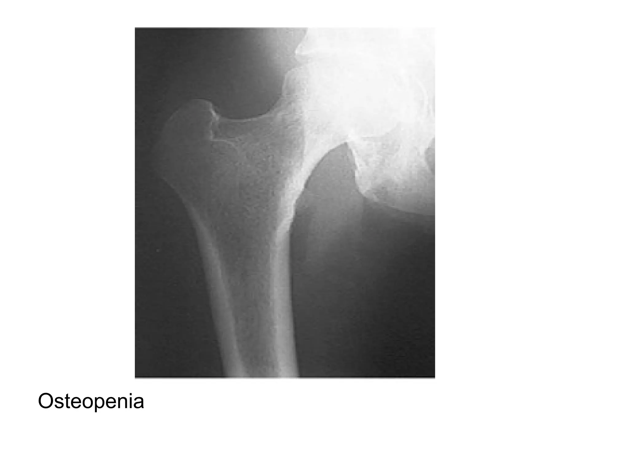 Diagnostic Imaging of Osteopenia | PPT