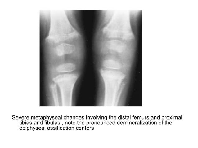 Diagnostic Imaging of Osteopenia | PPT