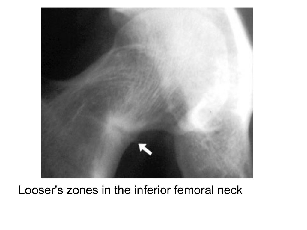 Diagnostic Imaging of Osteopenia