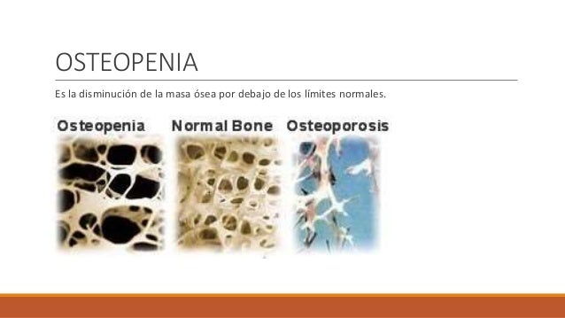 Osteopenia