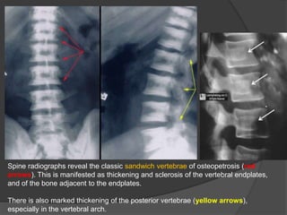 Osteopetrosis | PPTX