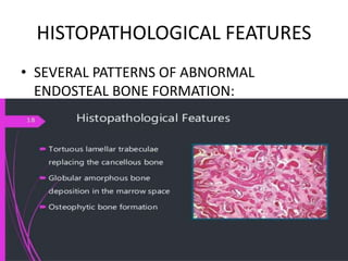 Osteopetrosis Histology