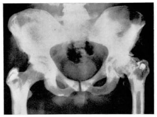 Osteopetrosis | PPTX