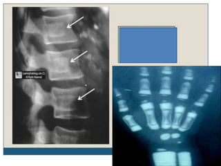 Osteopetrosis | PPTX