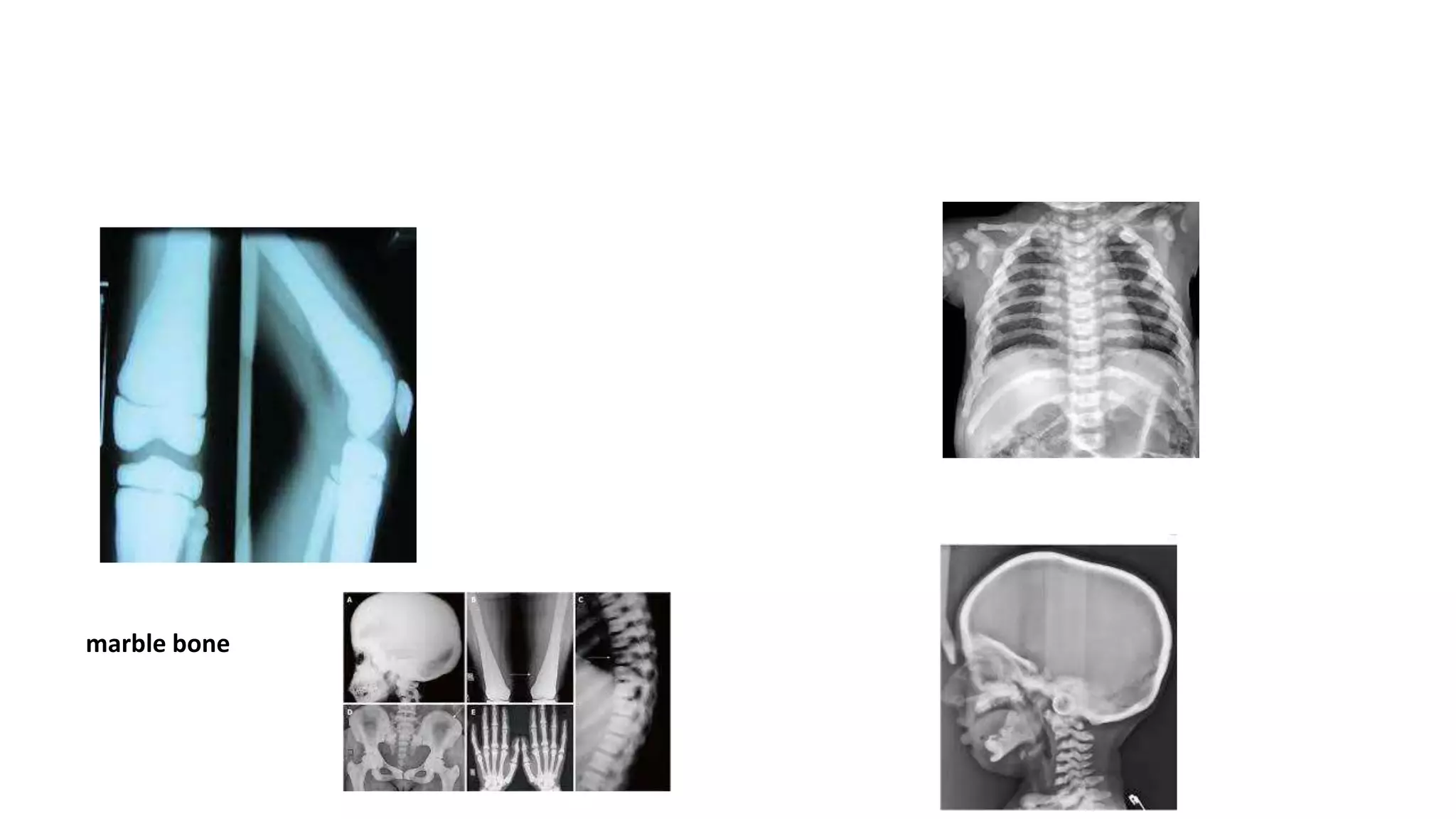 OSTEOPETROSIS NR.pptx