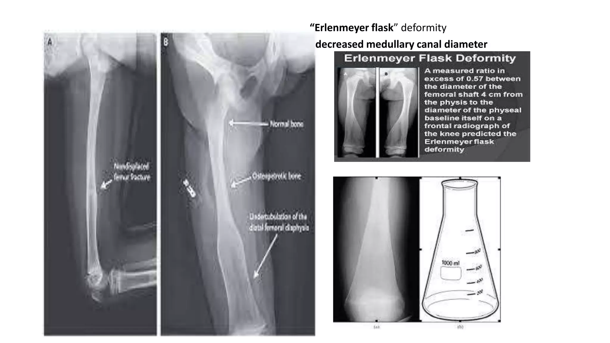 OSTEOPETROSIS NR.pptx