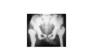 OSTEOPETROSIS NR.pptx