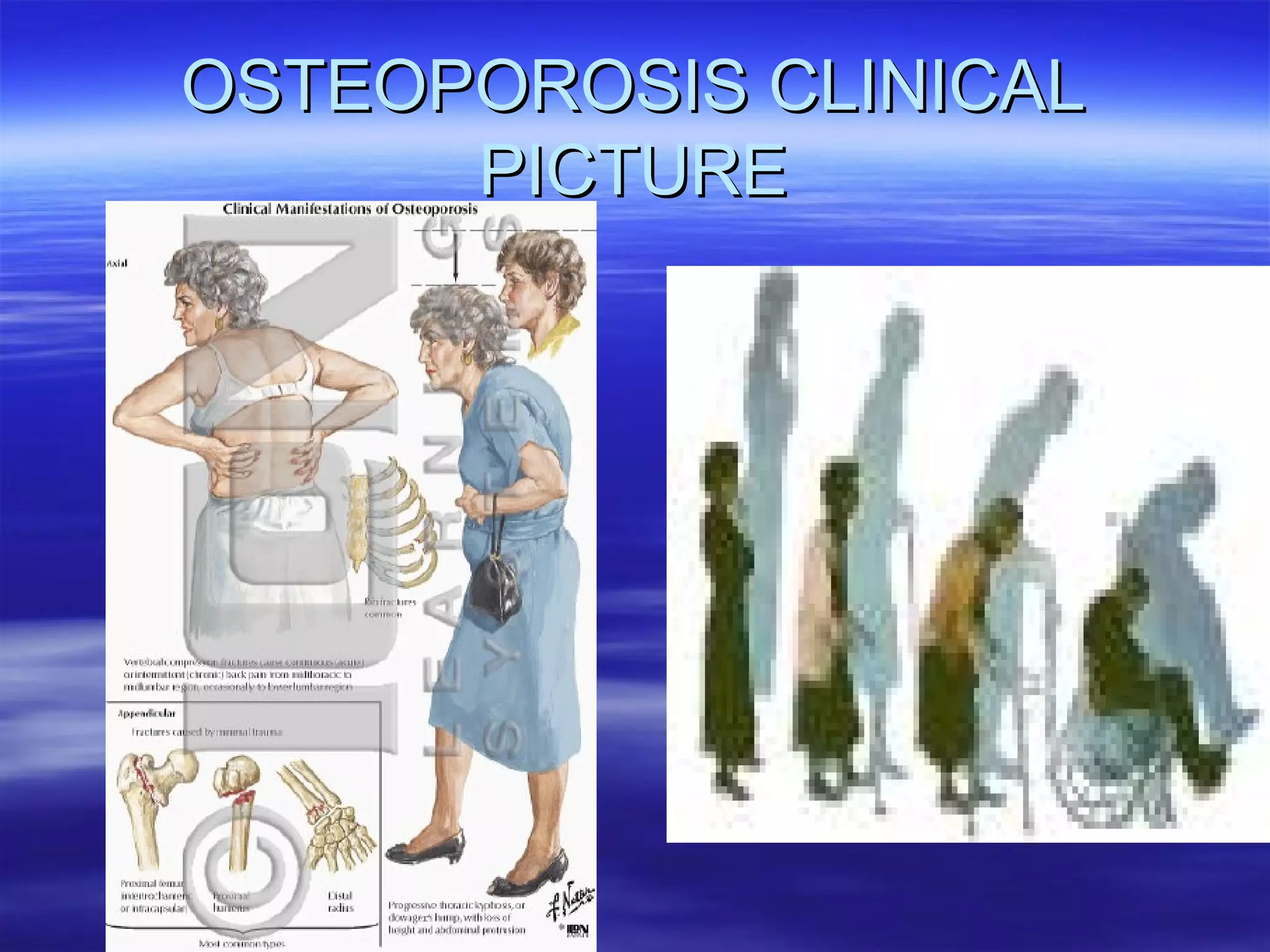 Osteoporosis | PPT