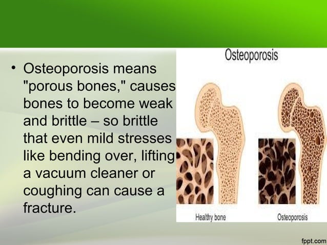 Osteoporosis diet and control | PPT | Bone and Joint Conditions | Diseases and Conditions
