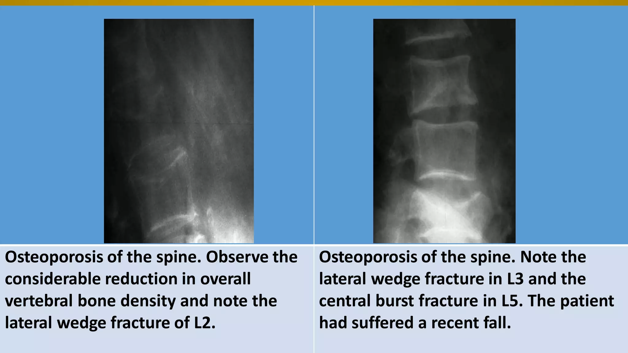 osteoporosis | PPTX
