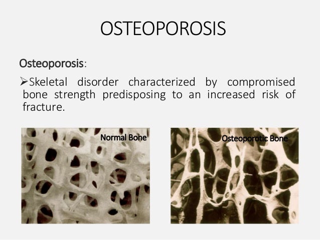 Osteoporosis
