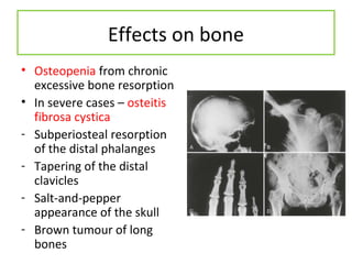 Osteoporosis | PPT