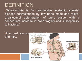 Osteoporosis | PPTX