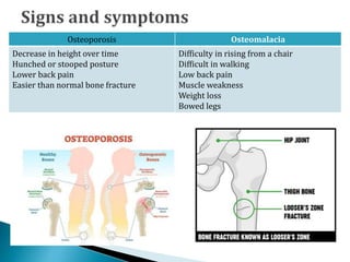 Osteoporosis and Osteomalacia | PPTX