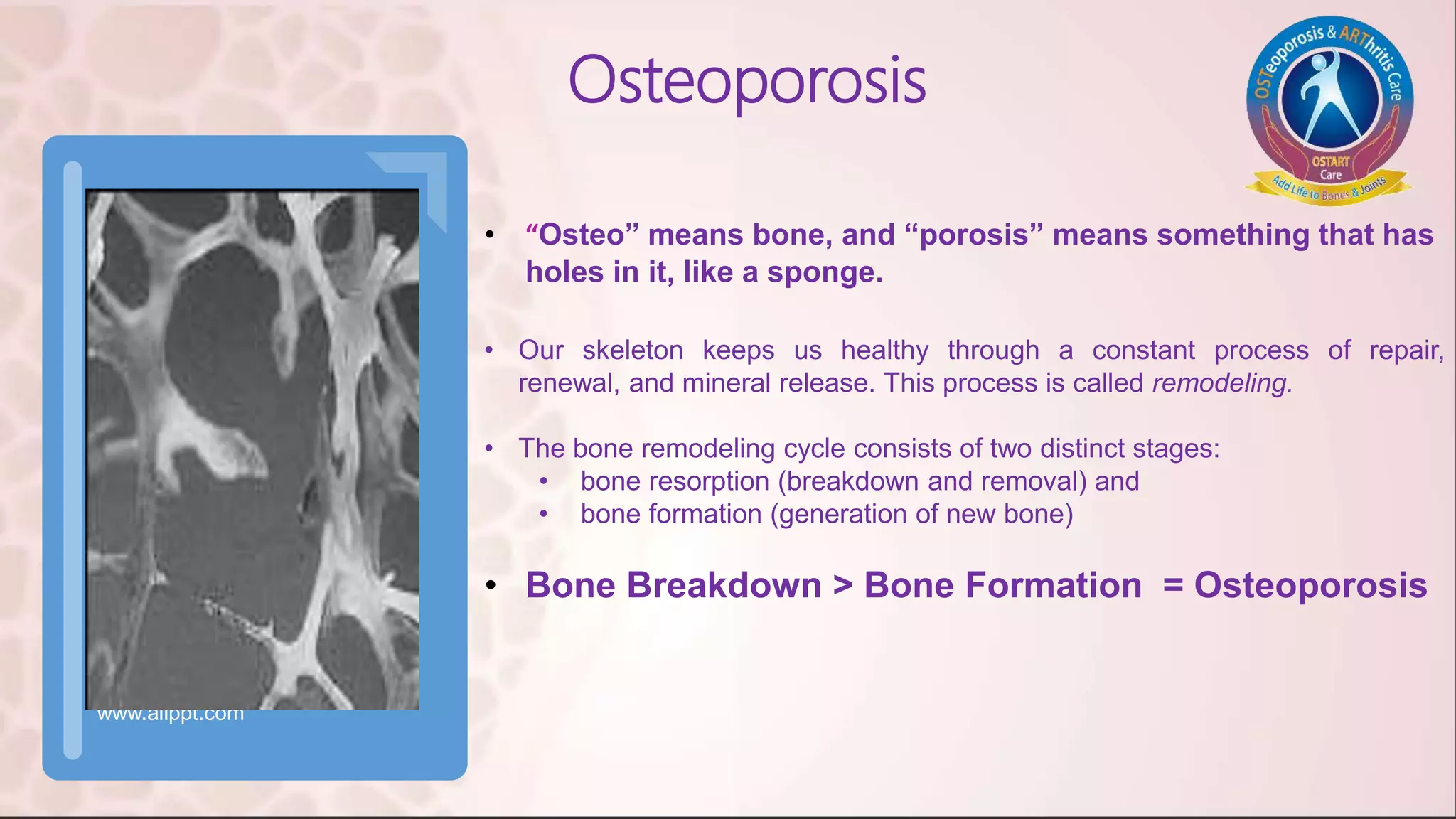 Osteoporosis | PPTX