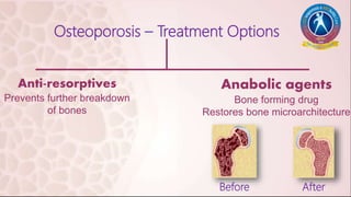 Osteoporosis | PPTX