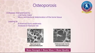 Osteoporosis | PPTX