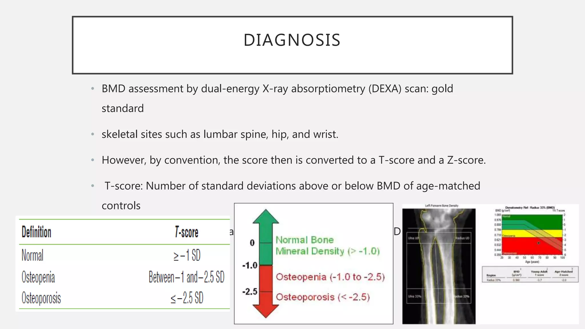 Osteoporosis | PPTX