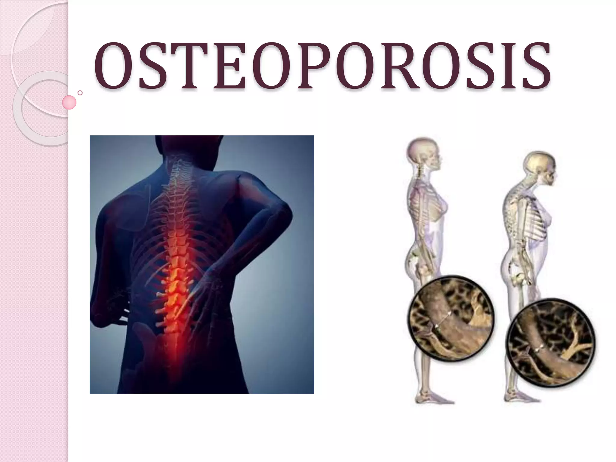 OSTEOPOROSIS.pptx