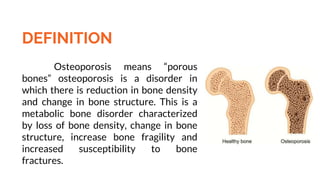 Osteoporosis.pptx