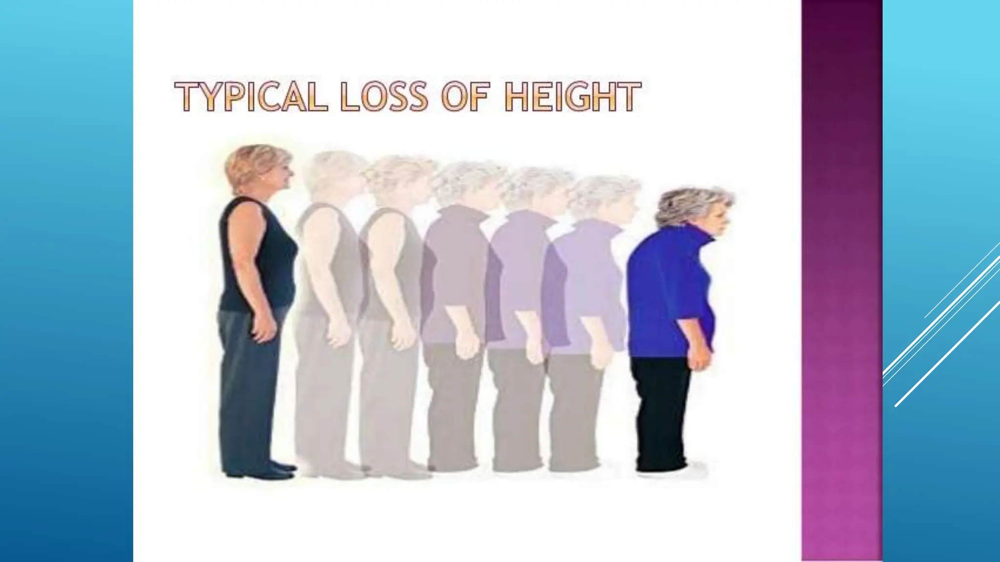 Osteoporosis Ppt For Nursing Students Pptx